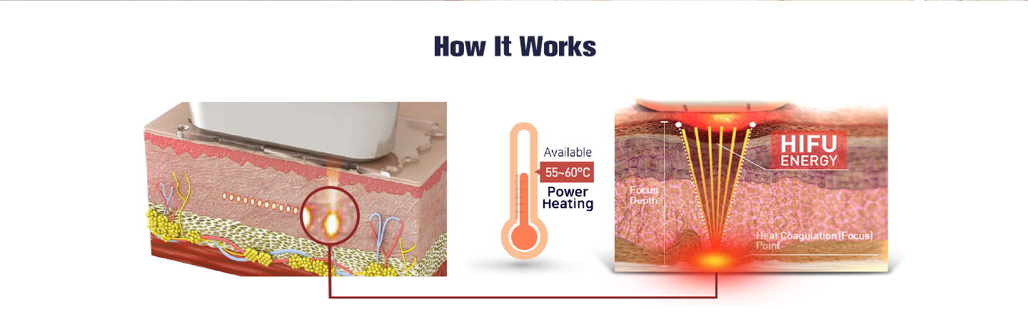 HIFU-powered transducers deliver concentrated waves of ultrasound into ...