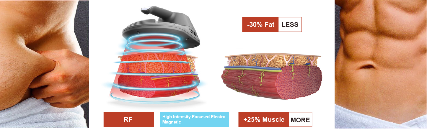 Musculpting neo is based on an applicator simultaneously emitting ...