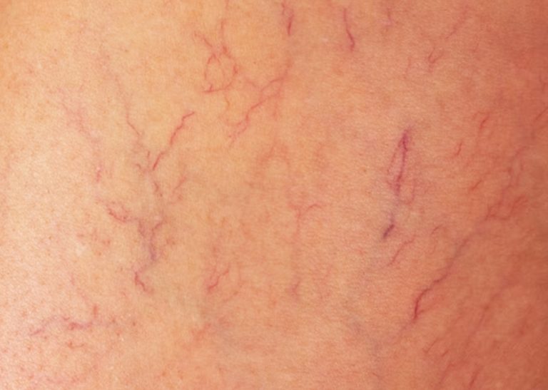 Red bloodshot skin is generally sensitive skin. In the initial stage of ...